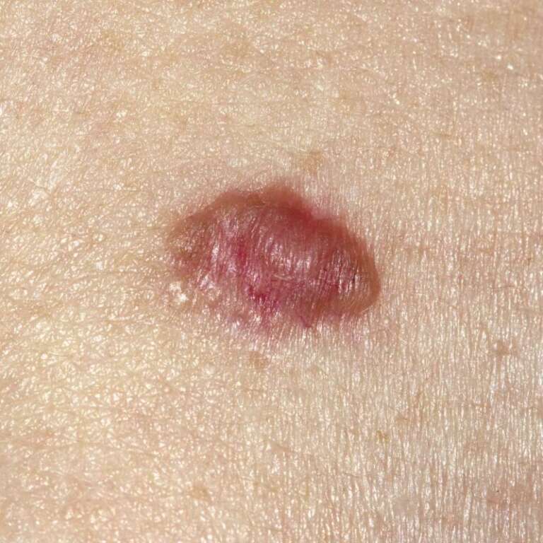 Carcinoma Basocelular - Dra. Michelle Tokarski